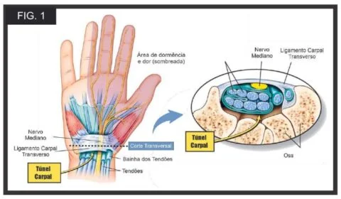 Síndrome do Túnel do Carpo em Bancários | MDN Advocacia